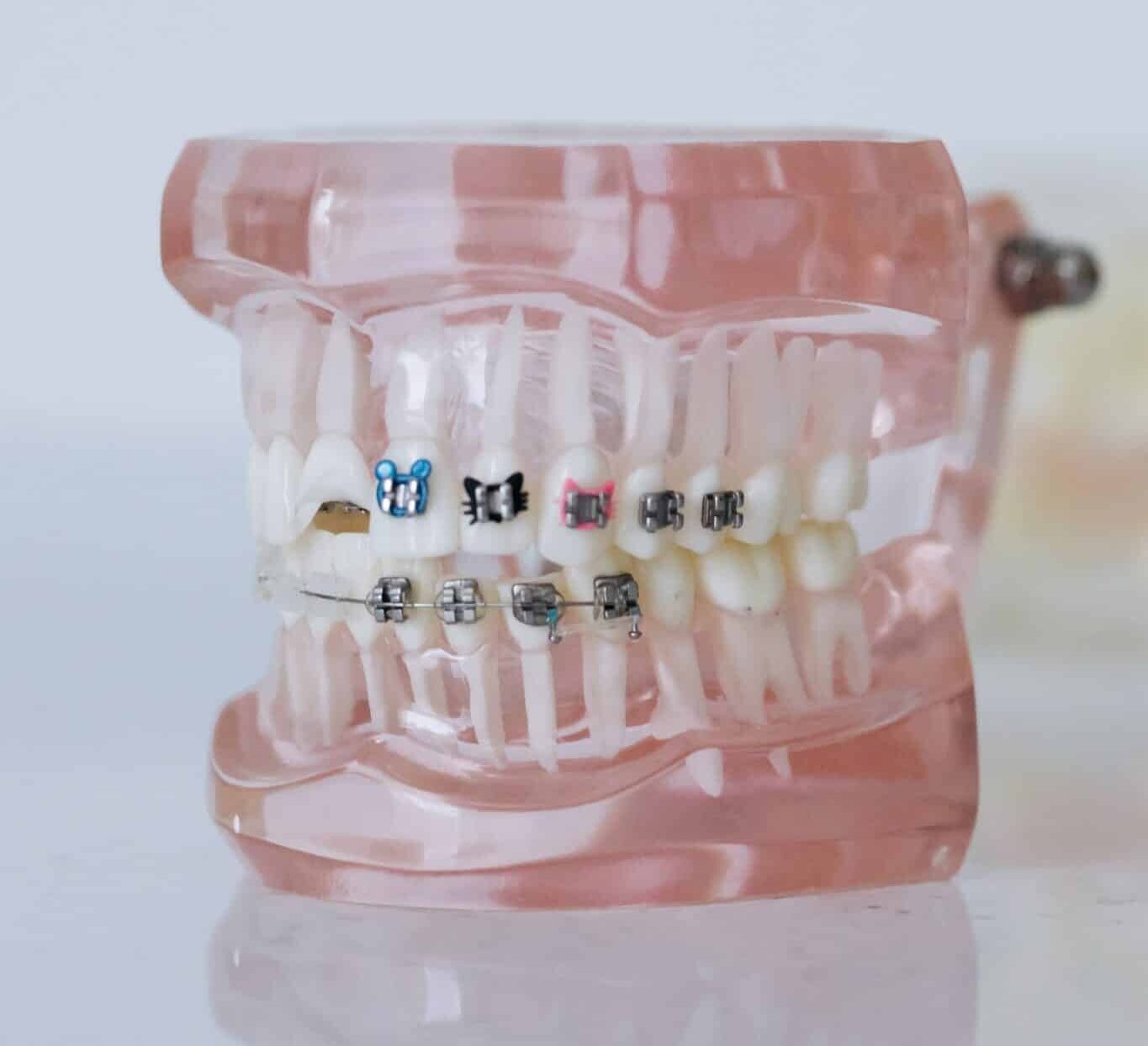 Getting Braces as an Adult. Why It’s a Popular Choice | OX Orthodontix